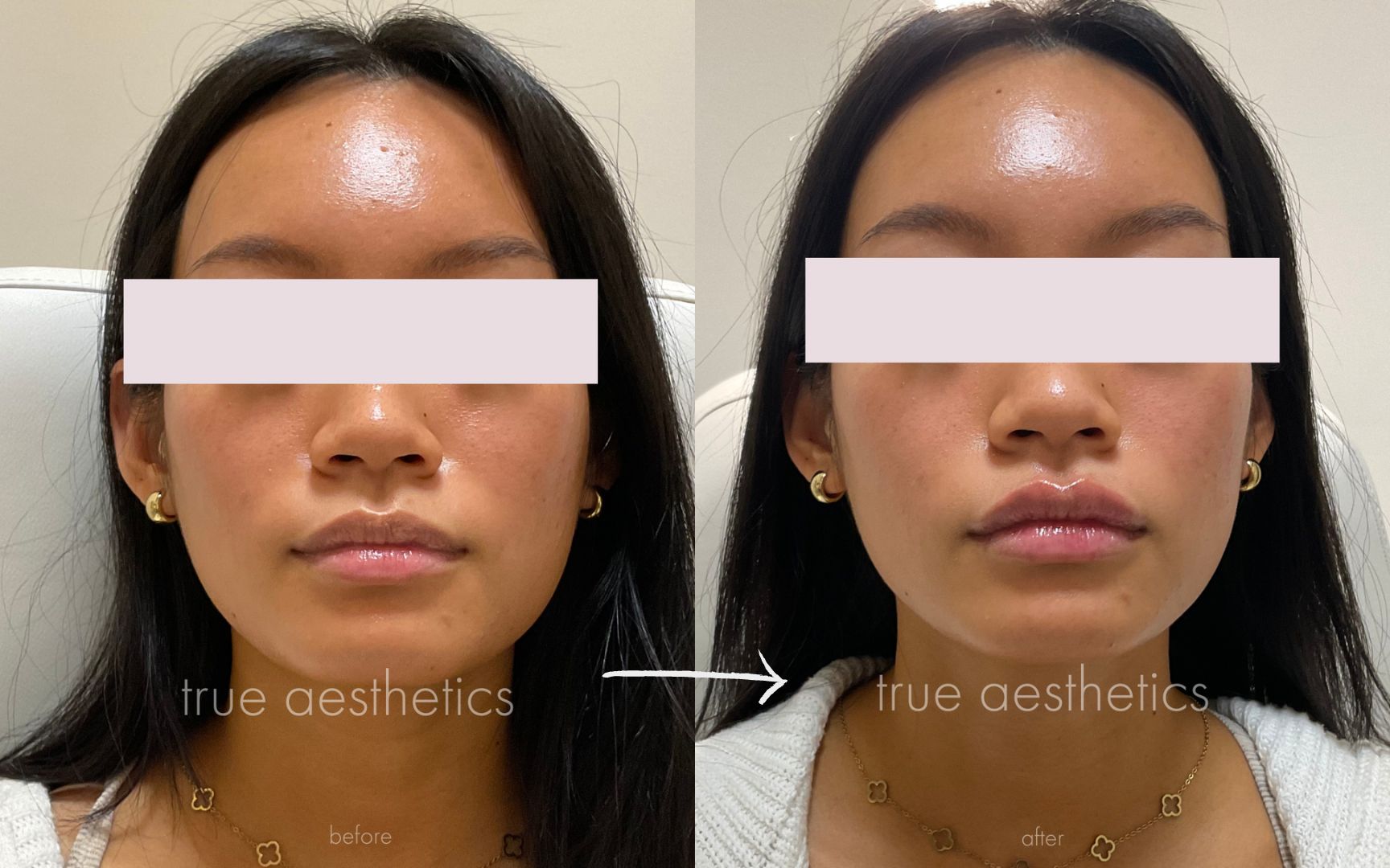 Dermal Filler: Lips - Explore Your Best Self at True