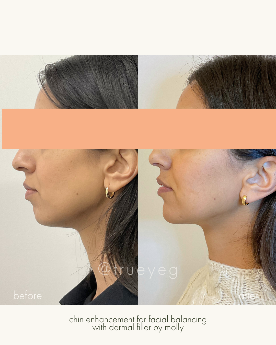 Chin Enhancement - True Aesthetics YEG